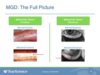 OPHTHALMOLOGY INNOVATION SHOWCASE - TearScience | PPT