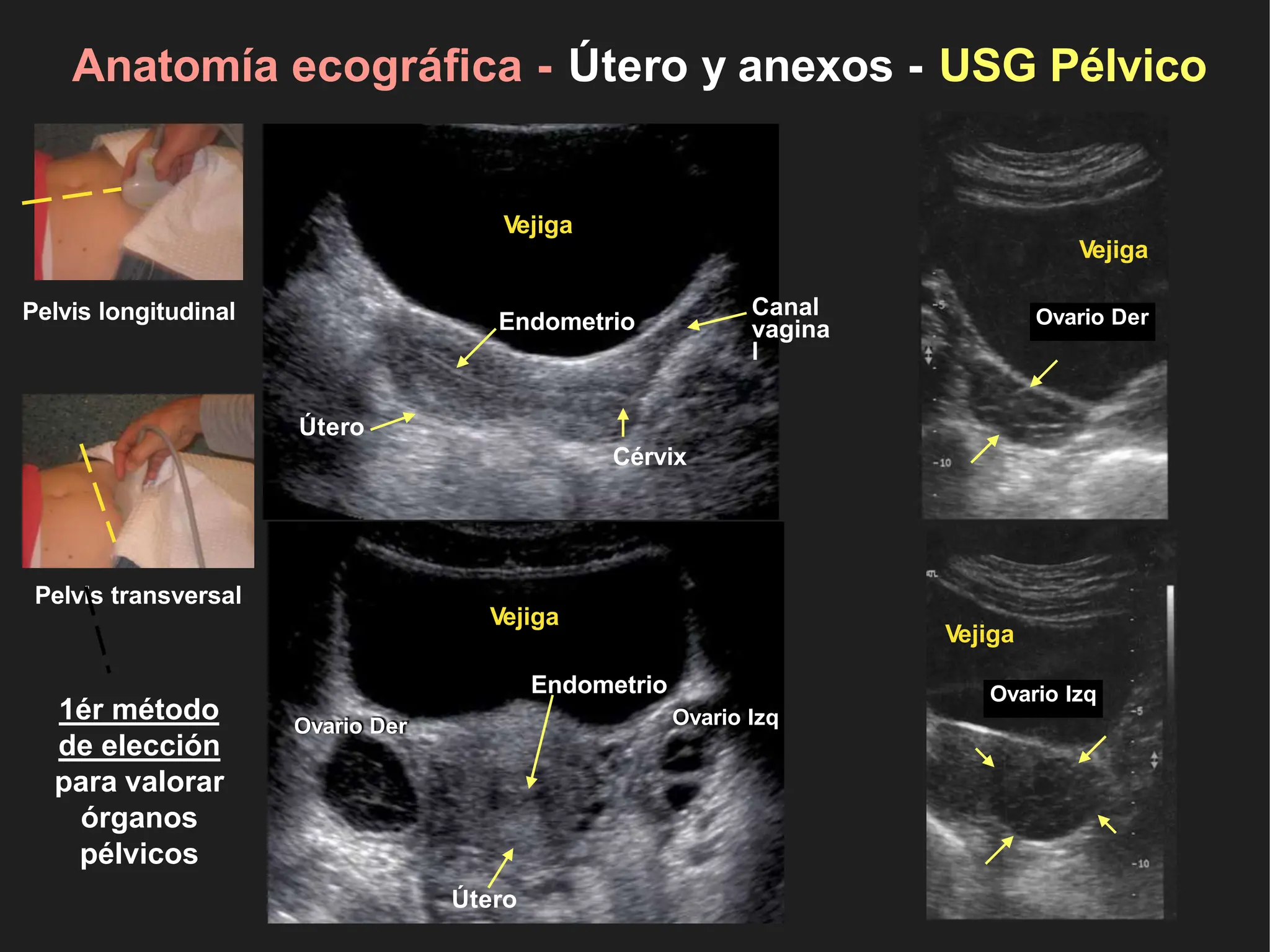 SESIÓN 11 - Ginecología - Útero y anexos.ppt