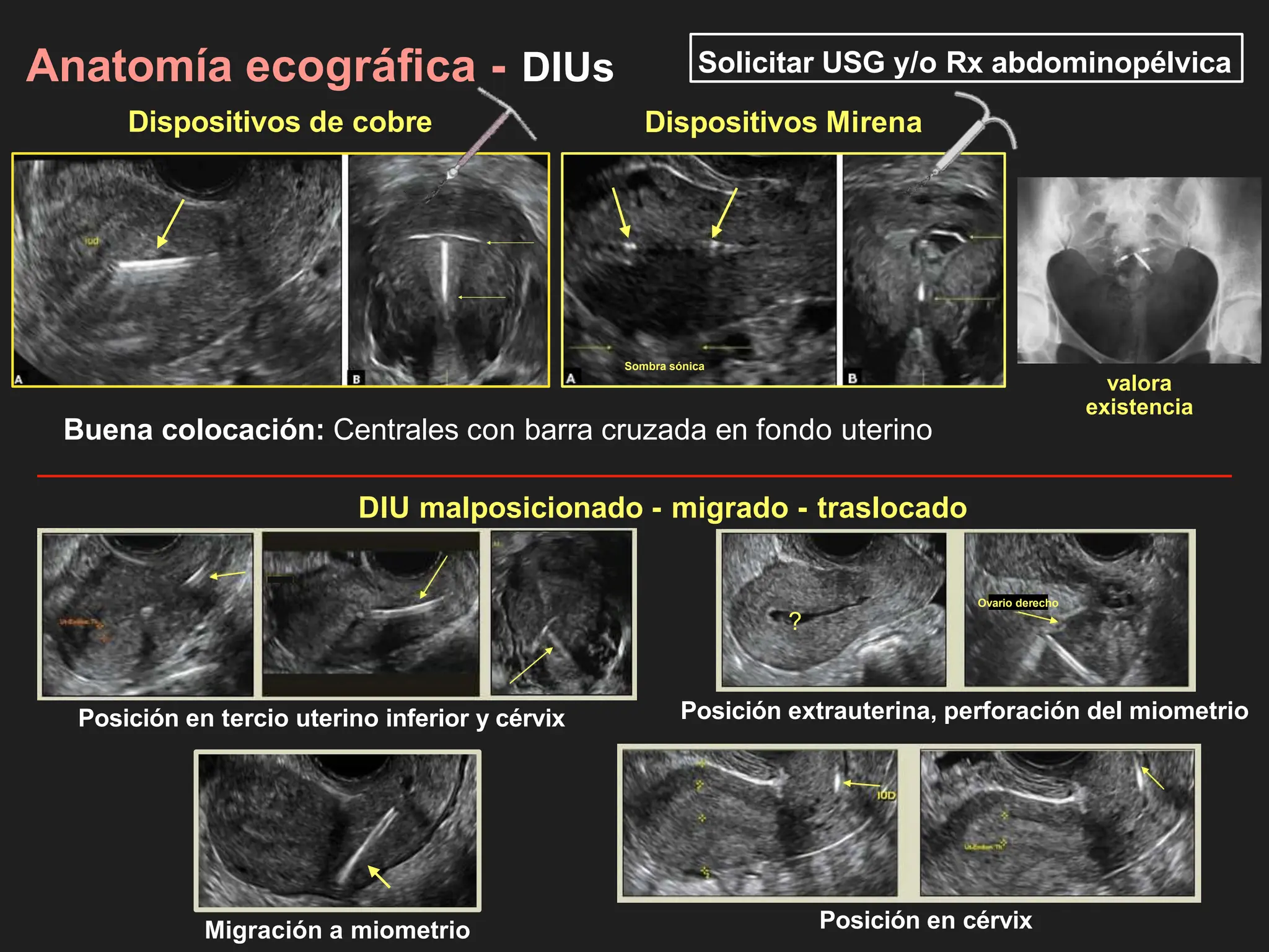 SESIÓN 11 - Ginecología - Útero y anexos.ppt