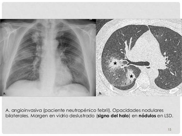 All the faces of aspergillosis