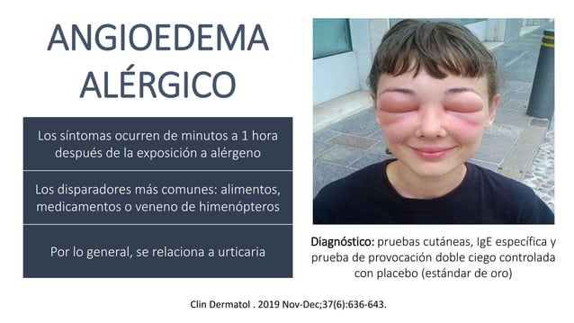 Caso Clínico: Abordaje de Angioedema | PPT