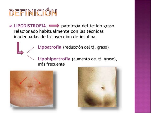 (2015-01-12)LIPODISTROFIASENELDIABETICO(PTT)