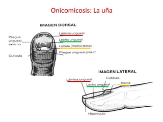 Onicomicosis | PPT