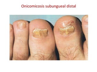 Onicomicosis | PPT