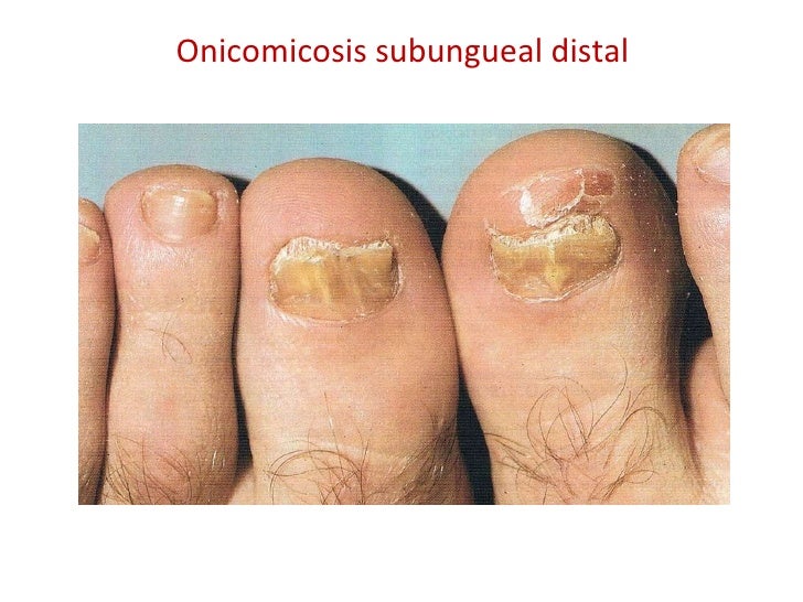 Onicomicosis