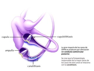 Tratamiento del vértigo posicional benigno | PDF