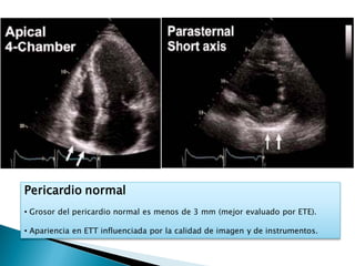 Evaluación ecocardiográfica en enfermedades del pericardio | PDF