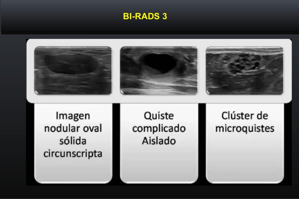 BI-RADS 5 EDICION