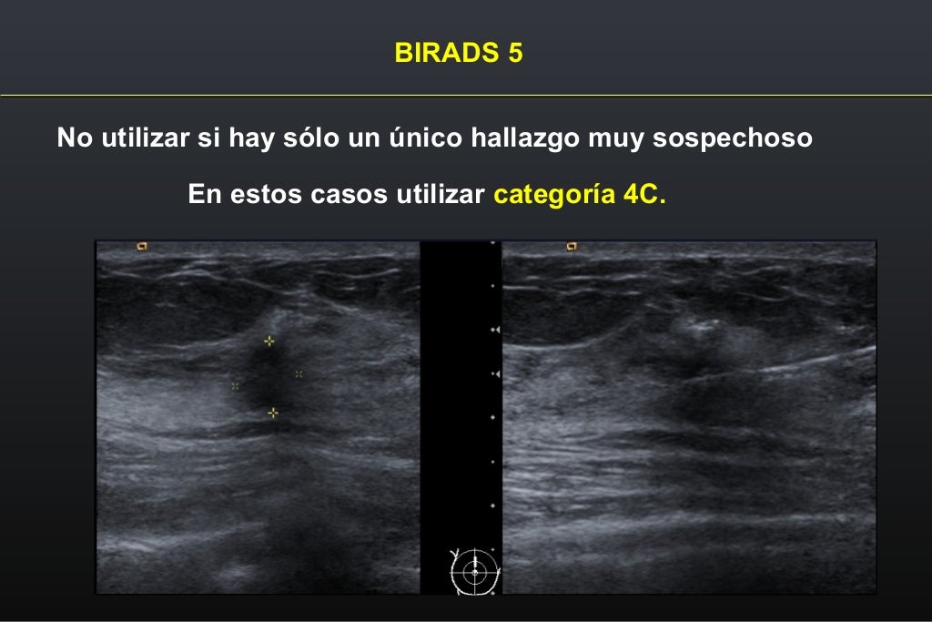 BI-RADS 5 EDICION