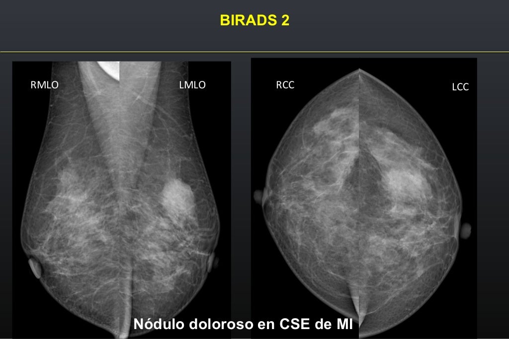 Mamografia Bi Rads 5 - RETOEDU