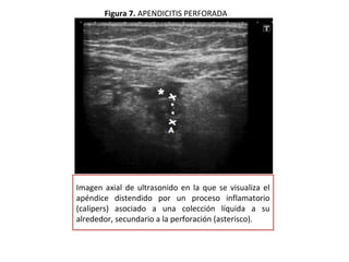 Sesión bibliográfica19 de Abril : Apendicitis | PPT