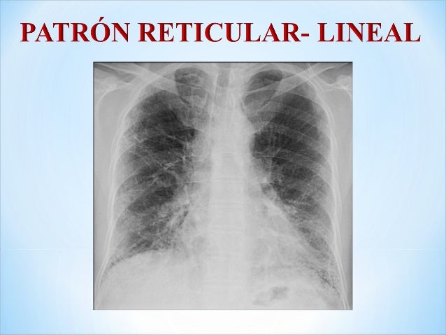 Patrones pulmonares