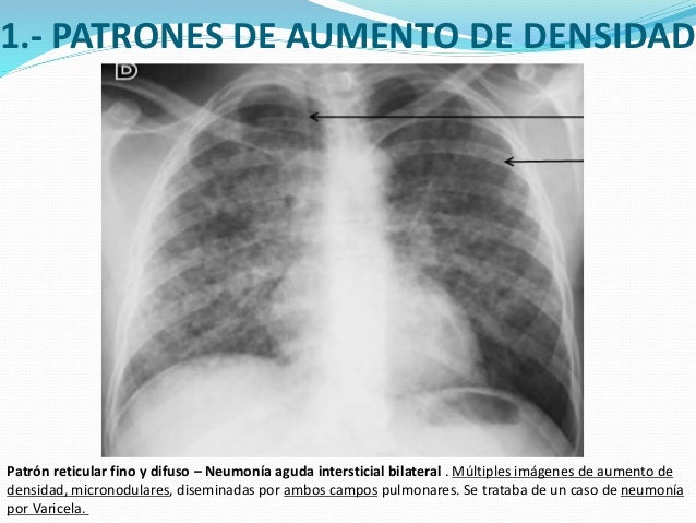 Principales patrones radiológicos en la placa simple de tórax