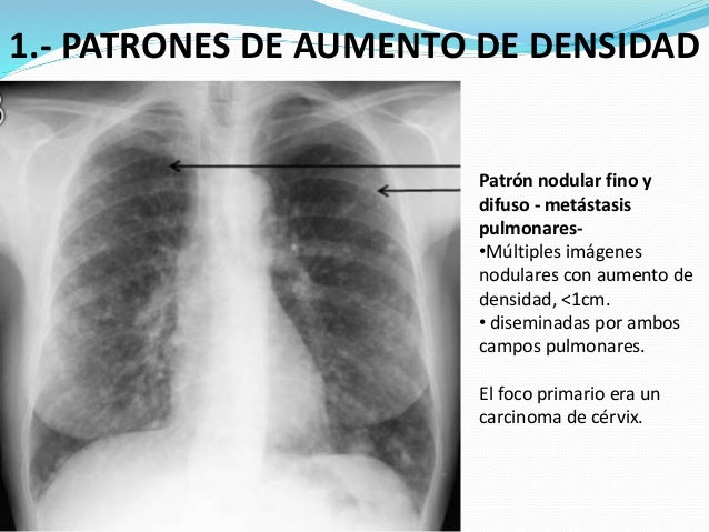Tac Torax Patron Nodular