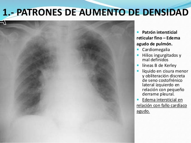 Principales patrones radiológicos en la placa simple de tórax