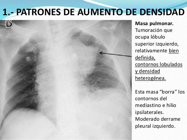 Principales patrones radiológicos en la placa simple de tórax