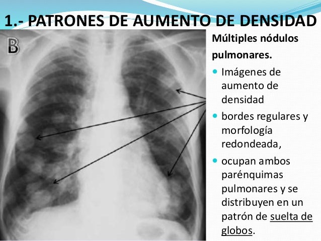Tac Torax Patron Nodular