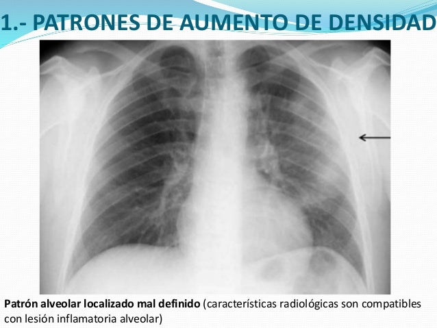Principales patrones radiológicos en la placa simple de tórax