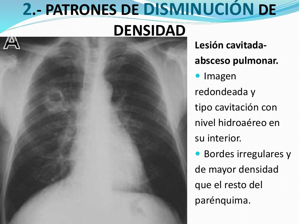 Principales patrones radiológicos en la placa simple de tórax