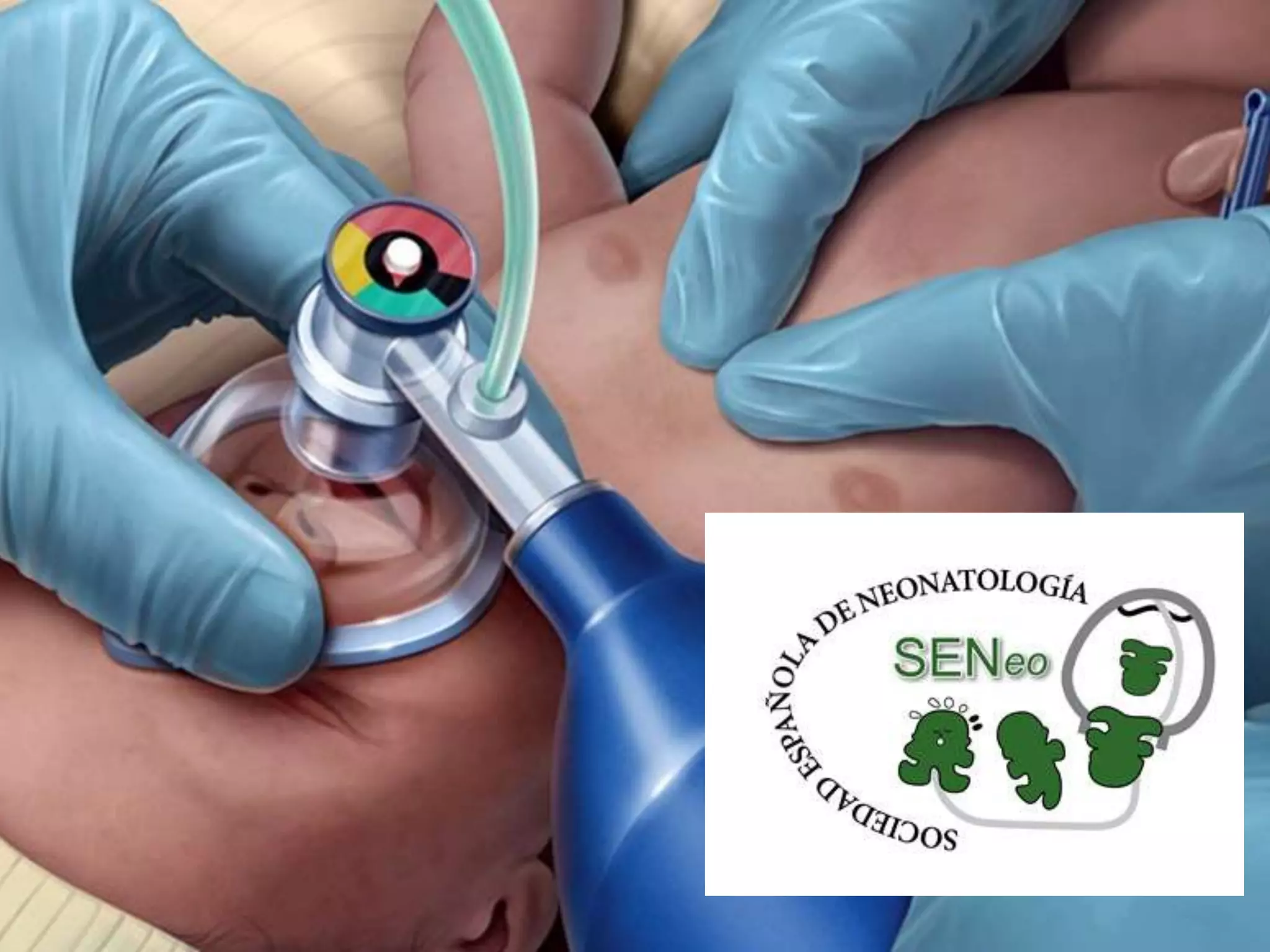 Reanimacion neonatal desde anestesia | PPTX