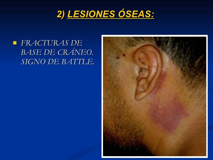 Sesion traumatismo craneoencefalico