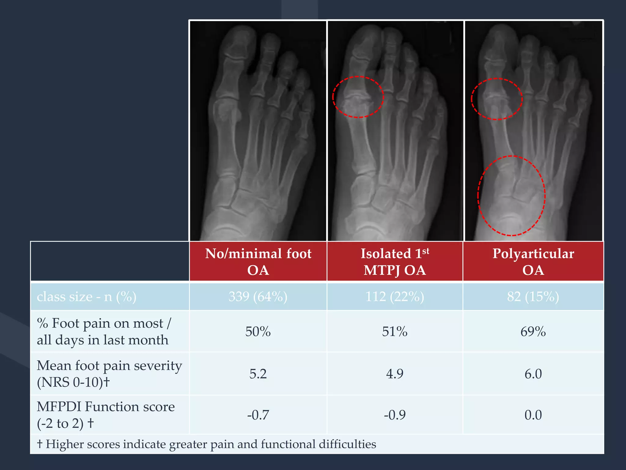 Osteoarthritis of the Foot and Ankle | PPTX