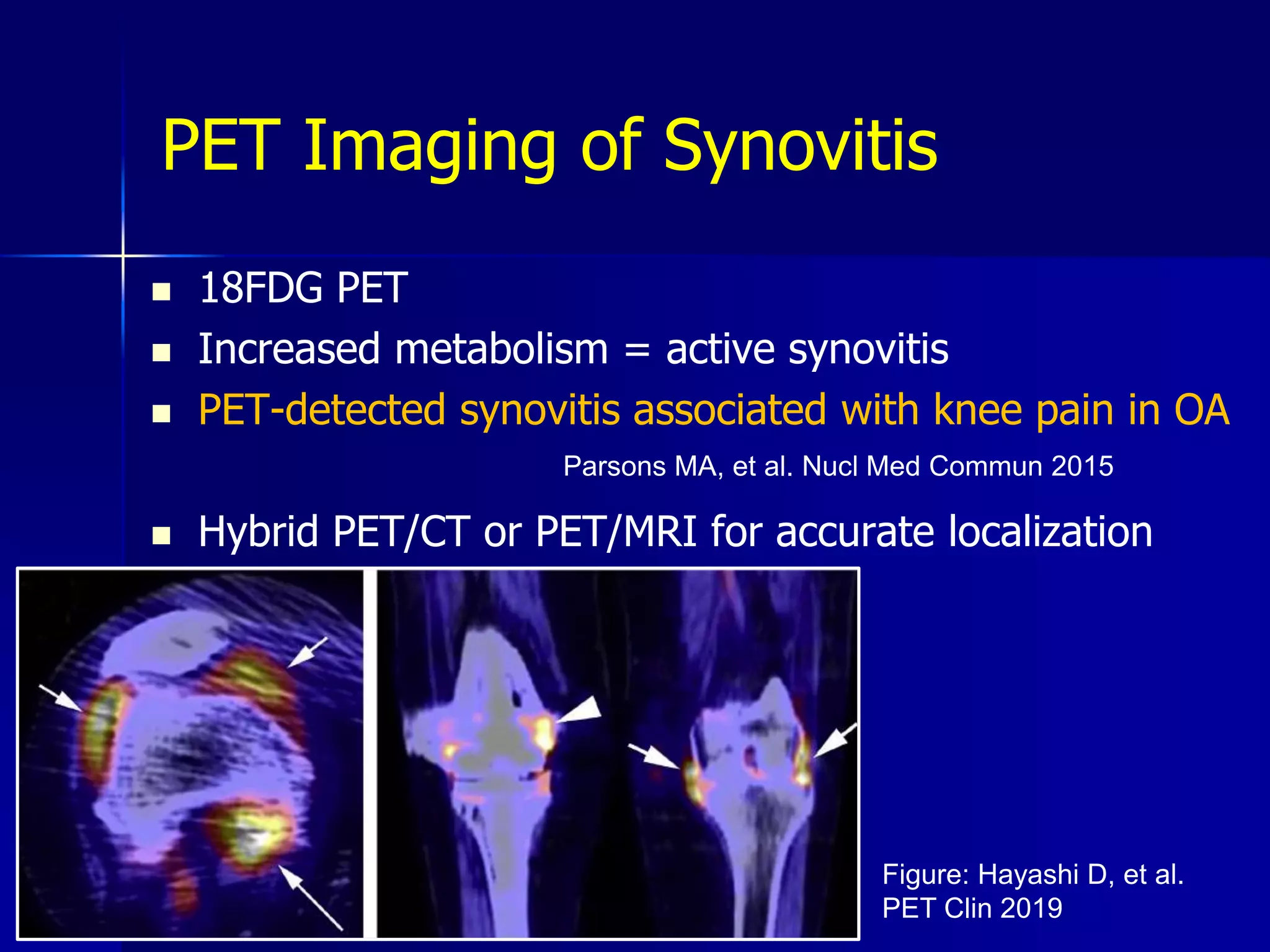 Imaging of Synovitis in OA | PPTX