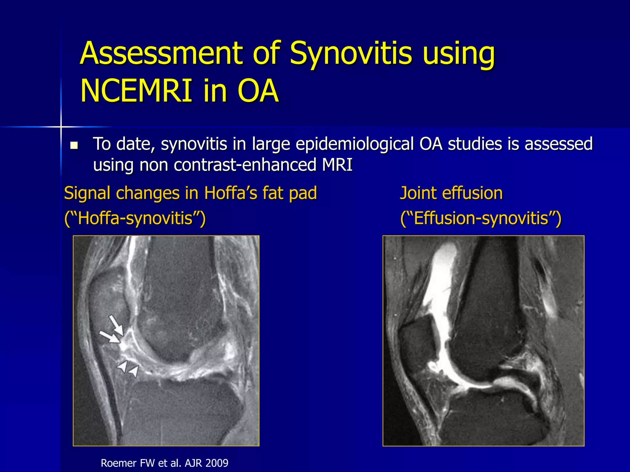 Imaging of Synovitis in OA | PPTX