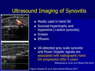 Imaging of Synovitis in OA | PPTX