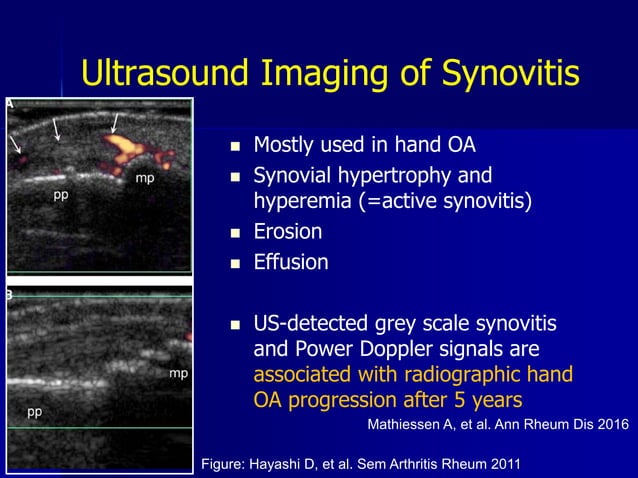 Imaging of Synovitis in OA | PPTX | Medical Tests | Medical Health