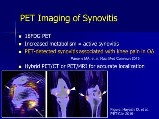 Imaging of Synovitis in OA | PPTX