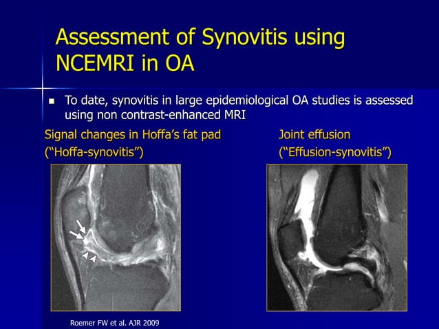 Imaging of Synovitis in OA | PPTX | Medical Tests | Medical Health