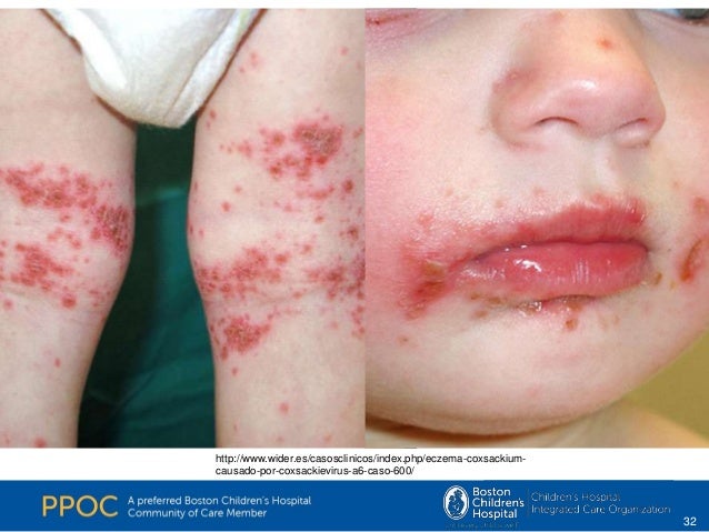 Session 1 Atopic Dermatitis Dermatology Lc 1 2