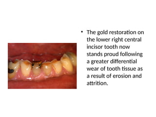 Session 11 Tooth wear and ooss of tooth substance.pptx