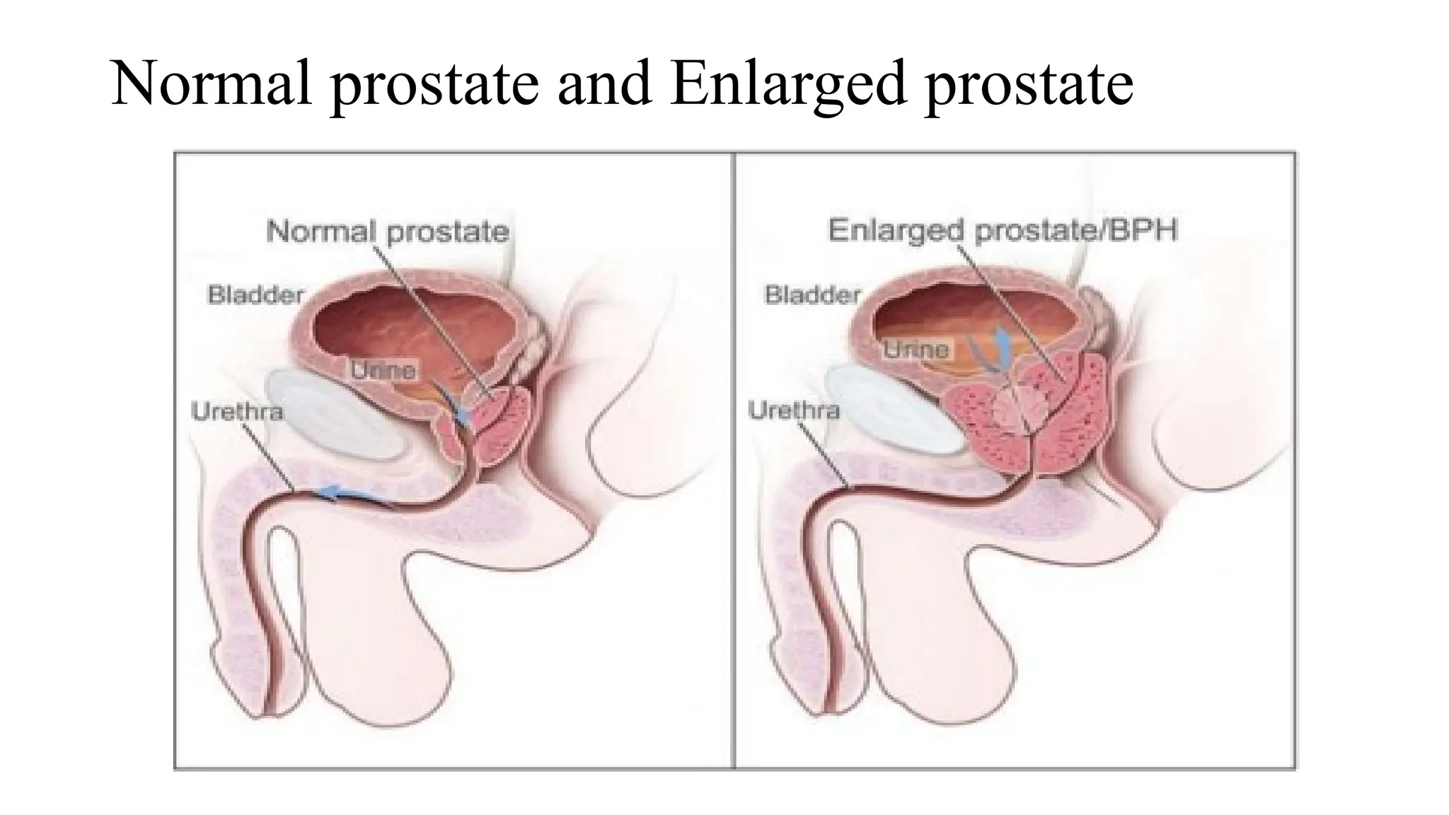 Session 14- Benign prostate hyperplasia(BPH).pptx