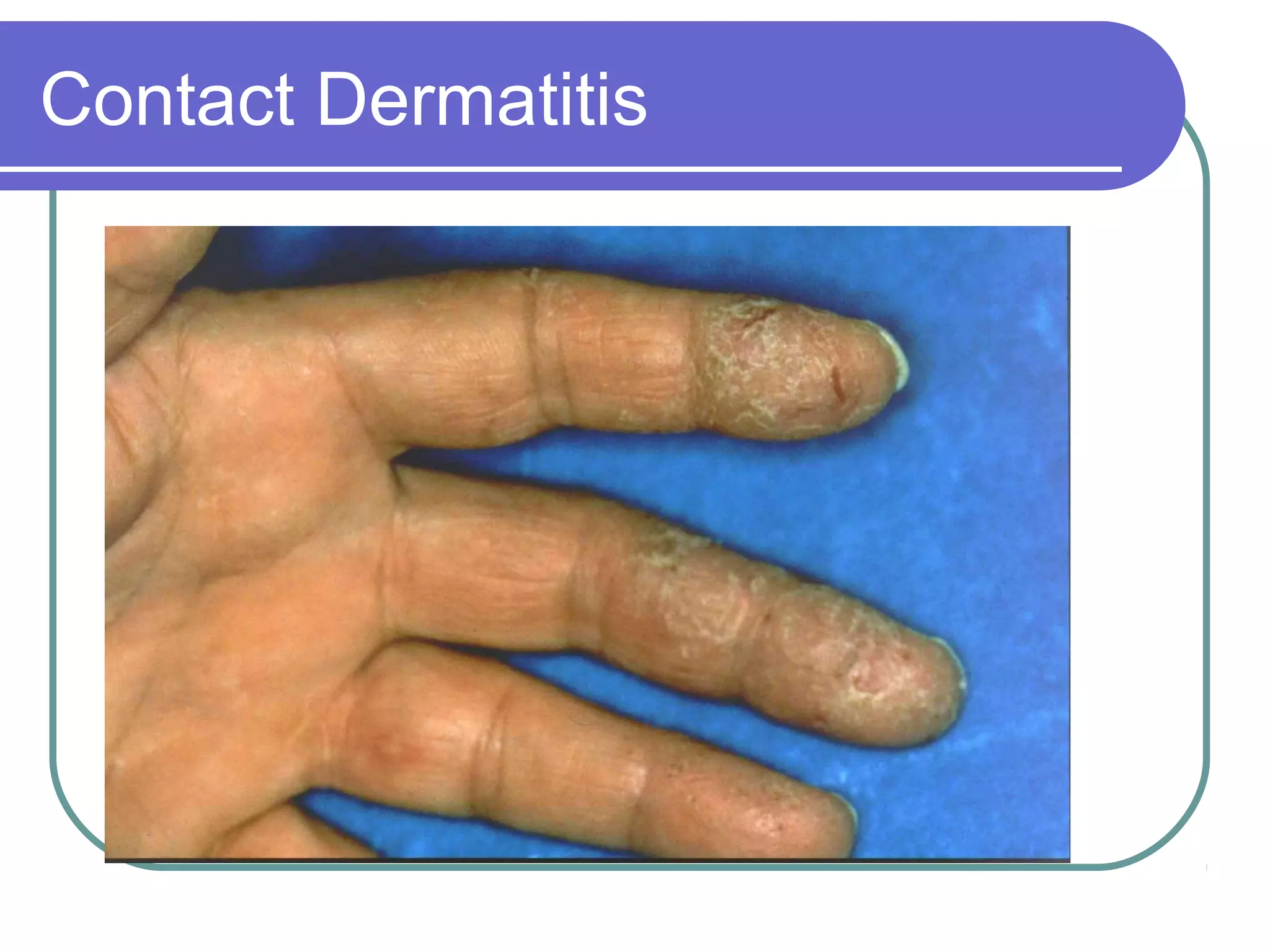 Dermatitis.ppt