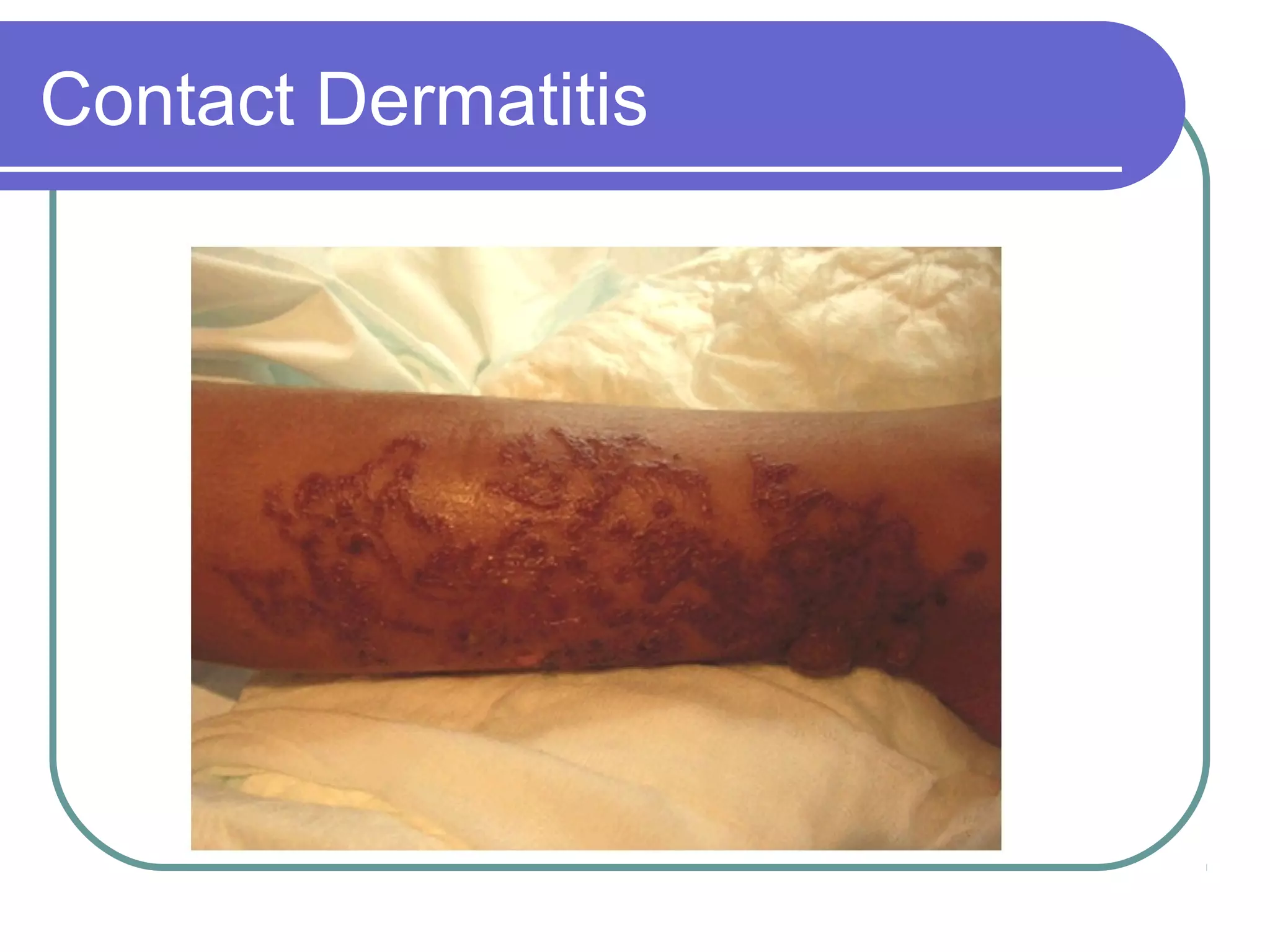 Dermatitis.ppt