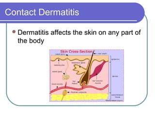 Dermatitis.ppt