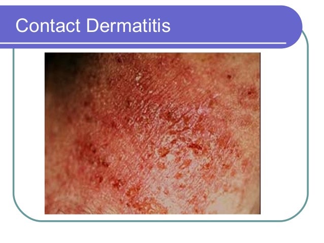 Dermatitis.ppt