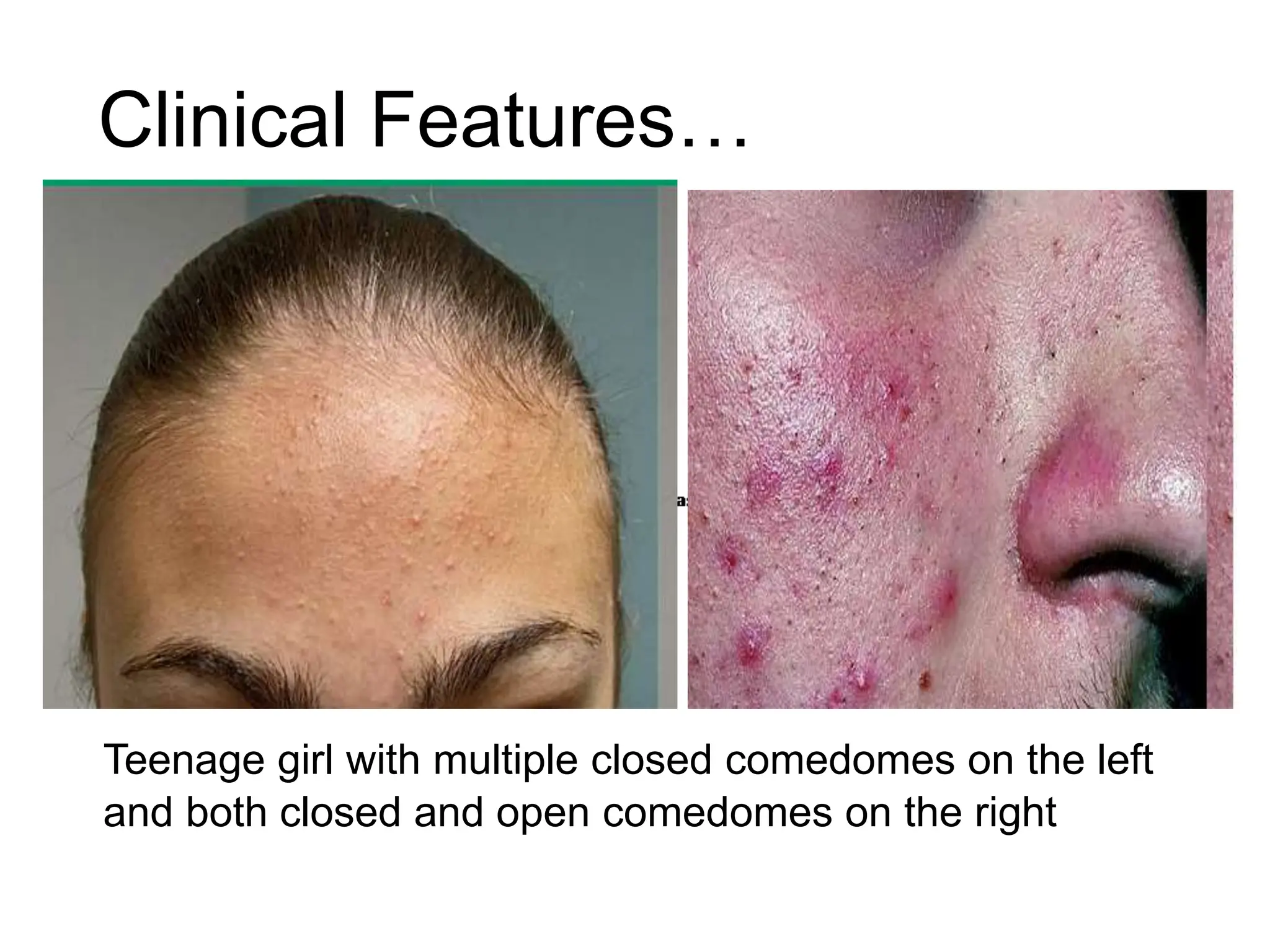 Session 23 Acne.pptx