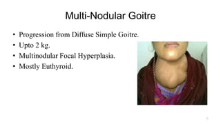 Goitre treatment and management accordingly | PPTX