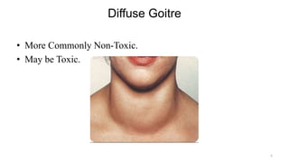Goitre treatment and management accordingly | PPTX