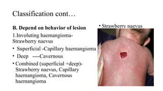 Session 9-Sebaceous Cyst and haemangioma.pptx