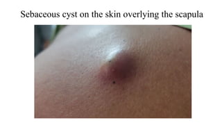 Session 9-Sebaceous Cyst and haemangioma.pptx