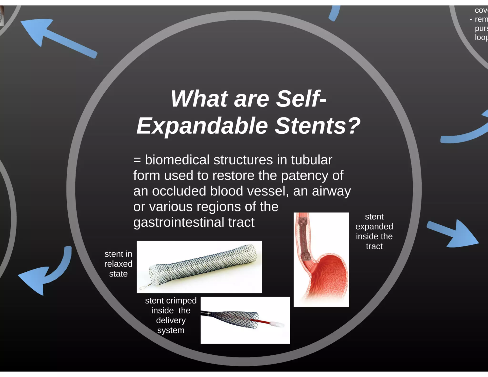 Self Expandable Stent Design | PDF