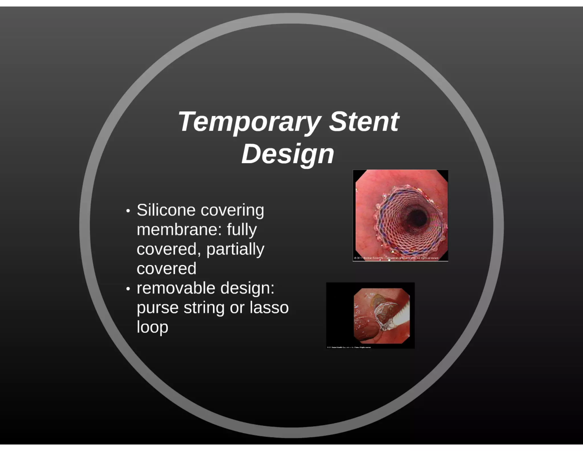 Self Expandable Stent Design | PDF