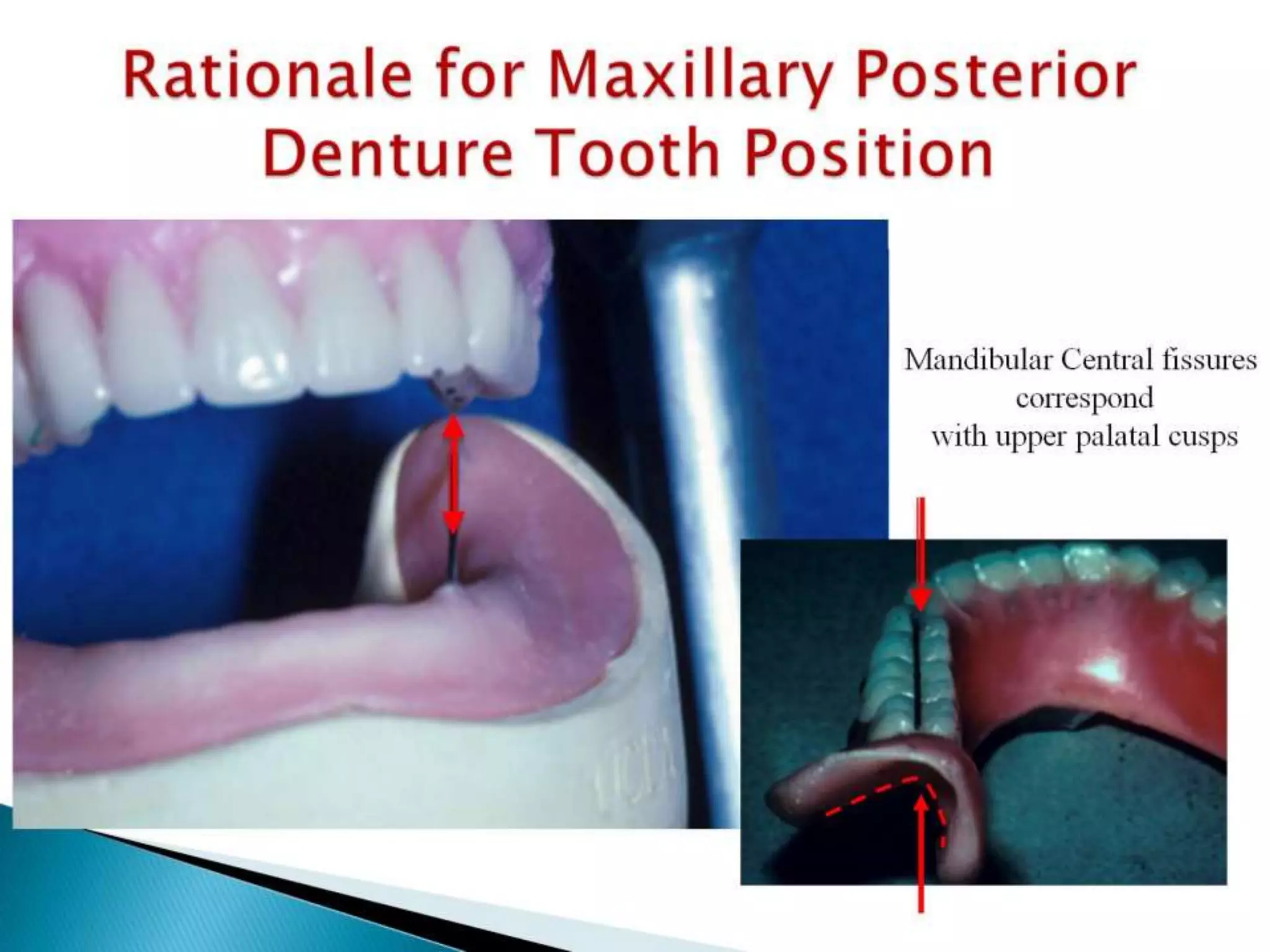 Setting maxillary posterior anatomic denture teeth cd 2nd yr | PPTX