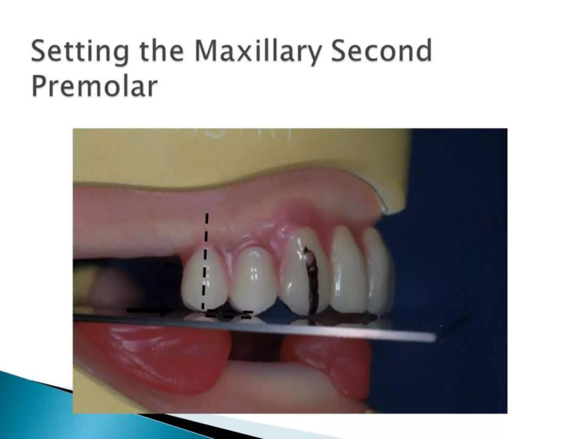 Setting maxillary posterior anatomic denture teeth cd 2nd yr | PPTX