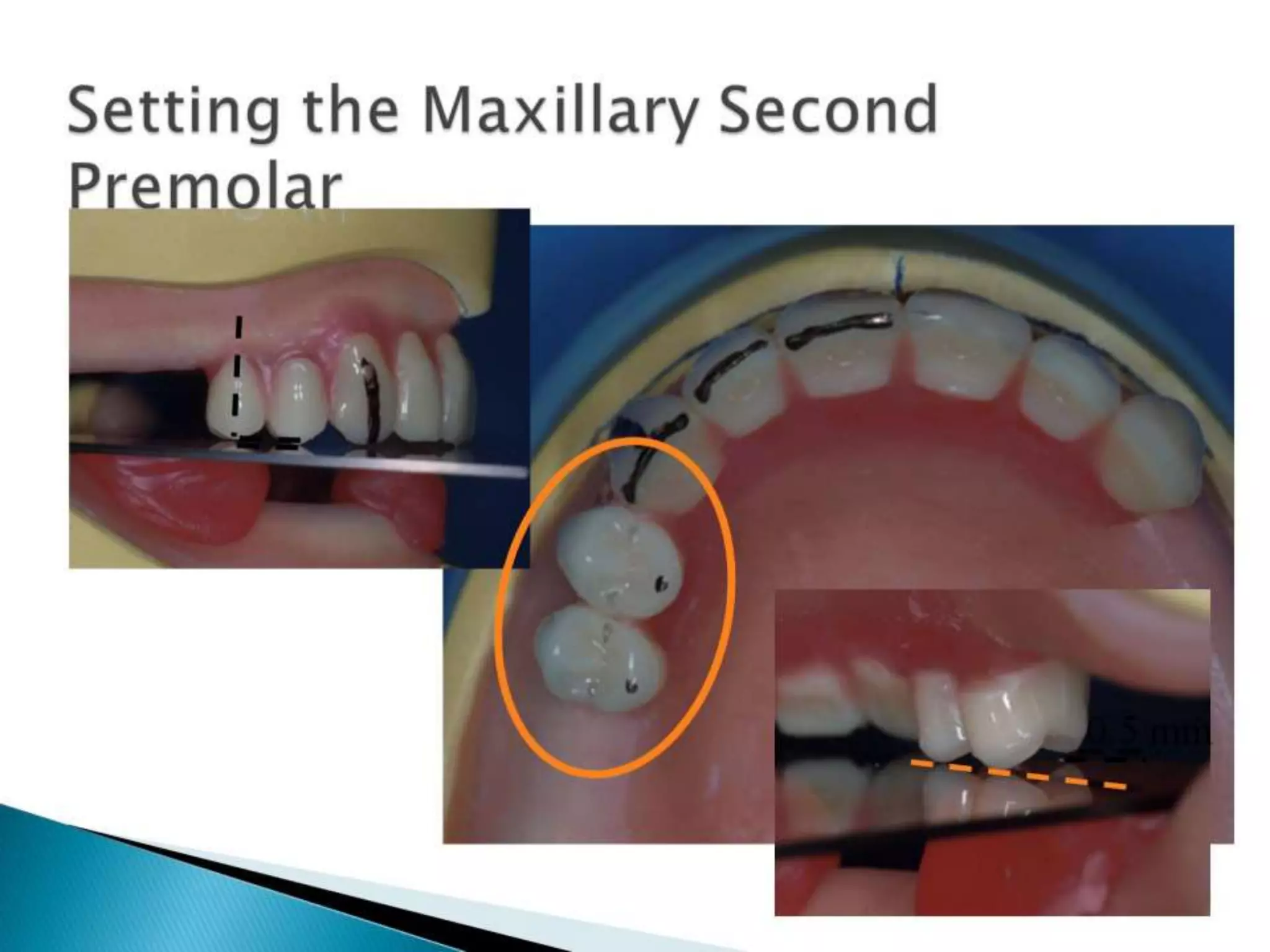Setting maxillary posterior anatomic denture teeth cd 2nd yr | PPTX