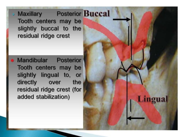 Setting maxillary posterior anatomic denture teeth cd 2nd yr | PPTX ...